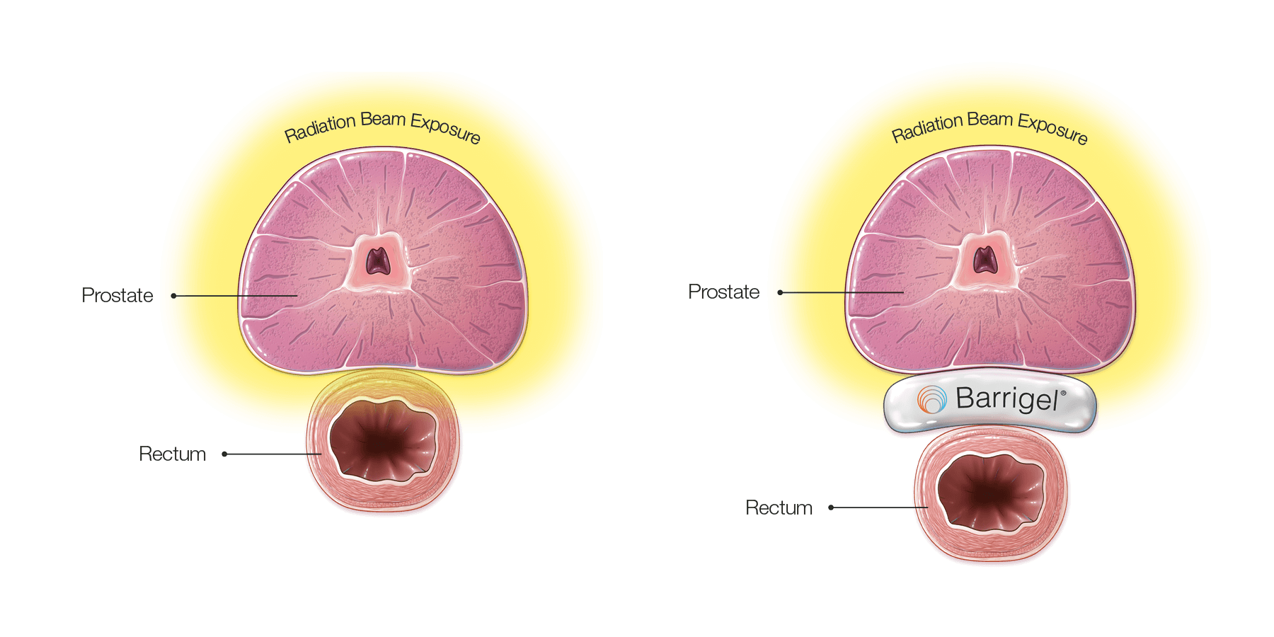 Barrigel Spacer - ASUI